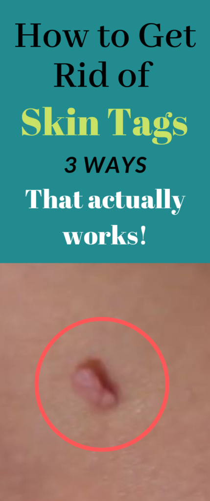 How to Get Rid of Skin Tags - 3 Ways That actually works - its-obvious